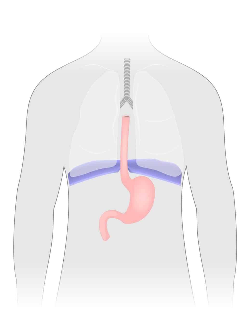 Zwerchfellbruch / Hiatushernie: nicht immer ungefährlich!