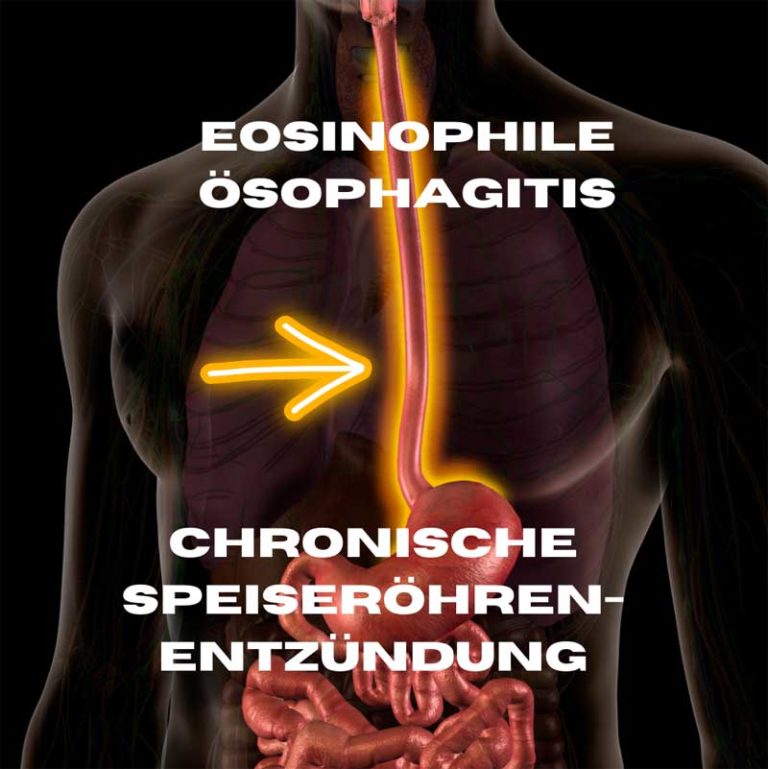Erkrankungen der Speiseröhre - Welche Erkrankungen gibt es?