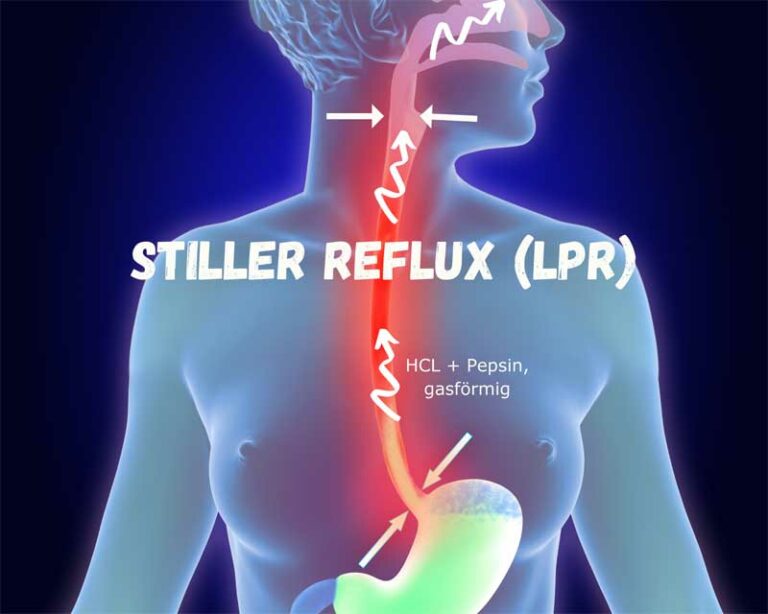 Stiller Reflux - die Symptome