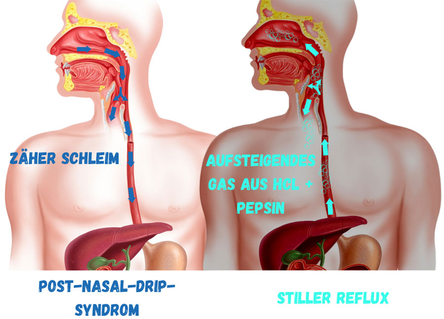 Post Nasal Drip Syndrom Und Stiller Reflux