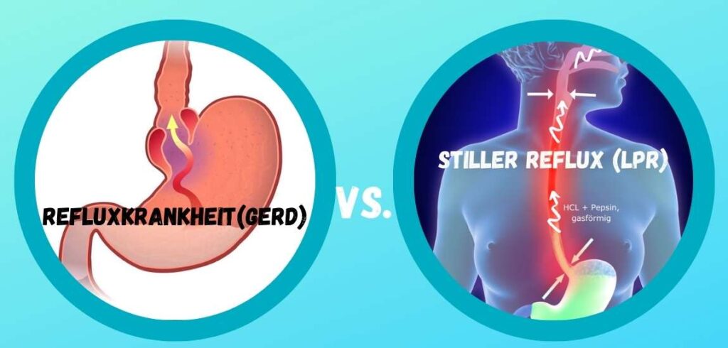 Refluxkrankheit vs. Stiller Reflux